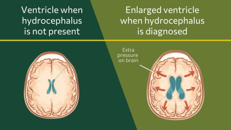 How We Honor Cerebral Palsy and Hydrocephalus Awareness - Mustard Seed ...